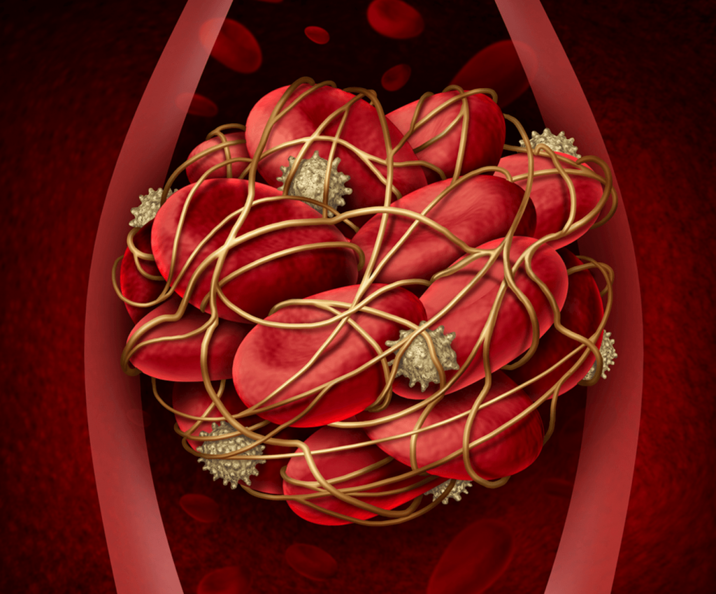 Deep Vein Thrombosis Prevention - Onto Orthopedics